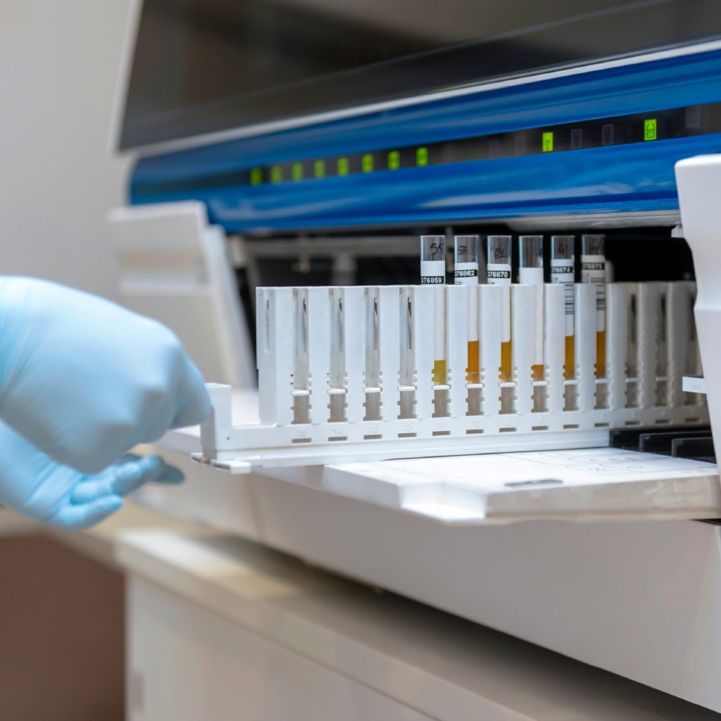 Anticuerpos anti-ribonucleoproteína (ANTI-RNP) | CHRISTUS MUGUERZA ...