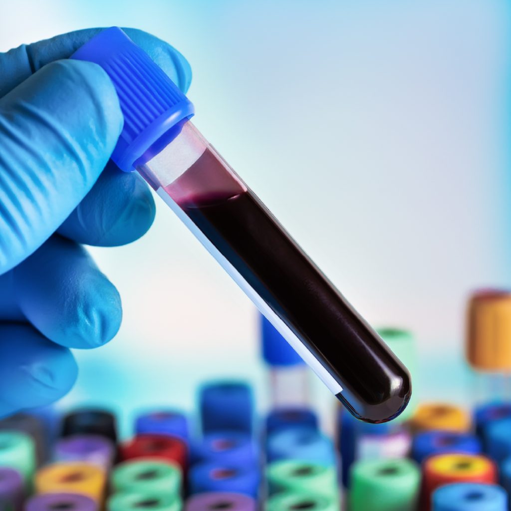 Anticuerpos anti-ribonucleoproteína (ANTI-RNP) | Christus Muguerza